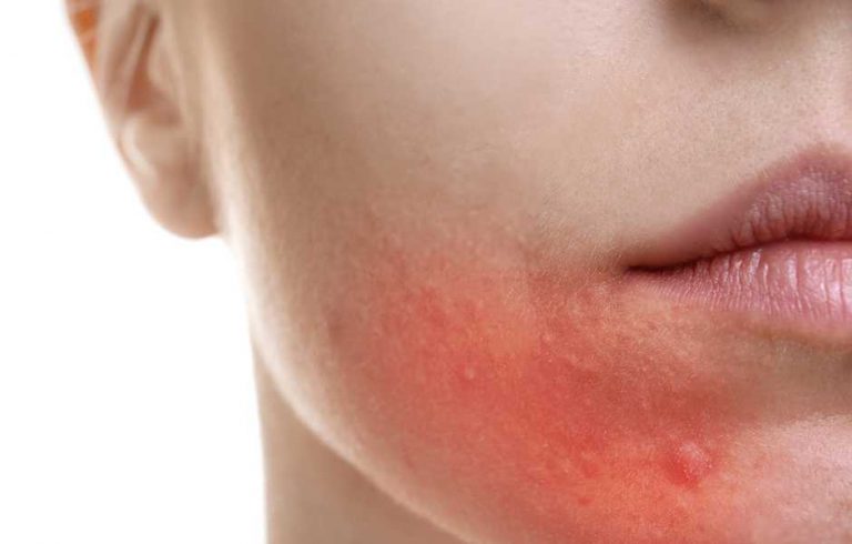 Come Eliminare i Brufoli e l'Acne? (7+) Rimedi Naturali!